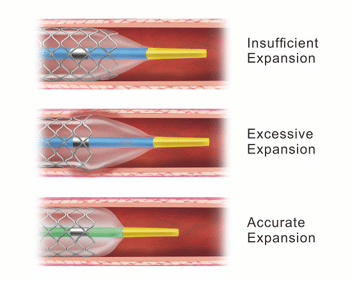 POT PTCA NC Balloon Catheter Launch | Angeion Medical